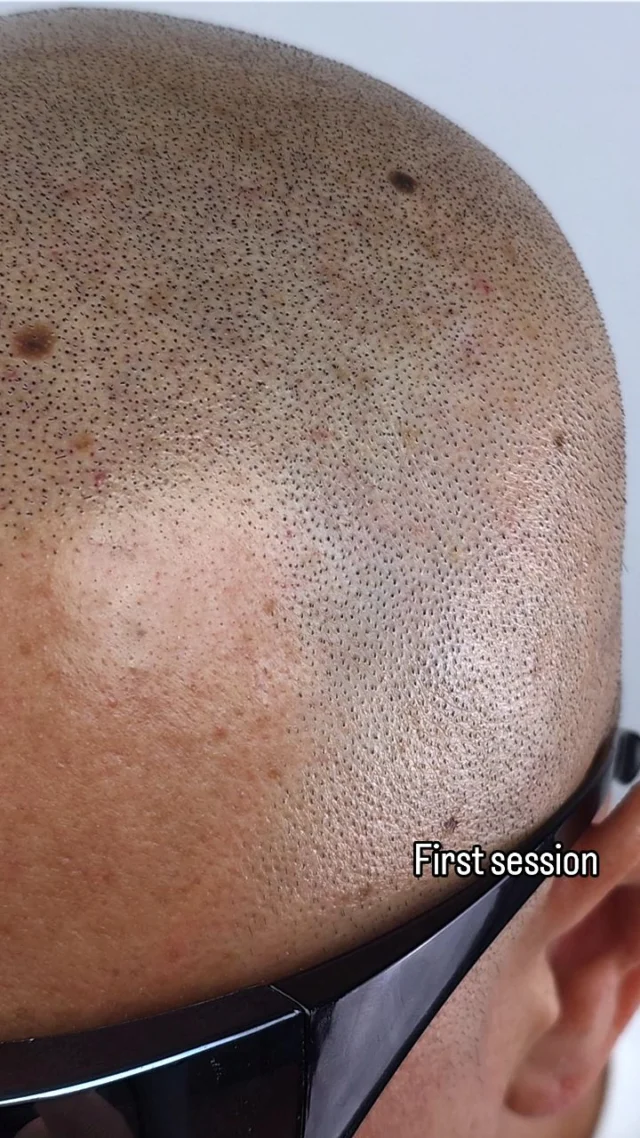 Scalp Micropigmentation Toronto | Enhanced Scalp